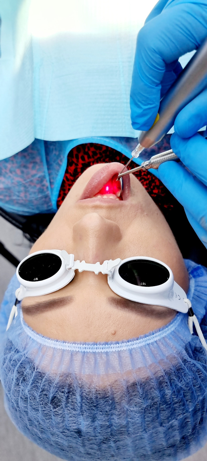 Frenectomia linguala cu laser la copii si adulti » 2026