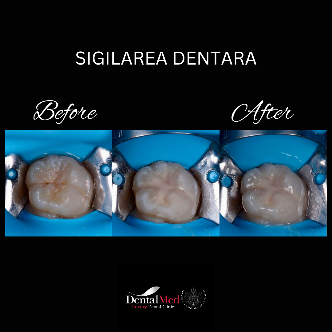 Sigilari dentare la copii - de ce sa alegi procedura [2025]