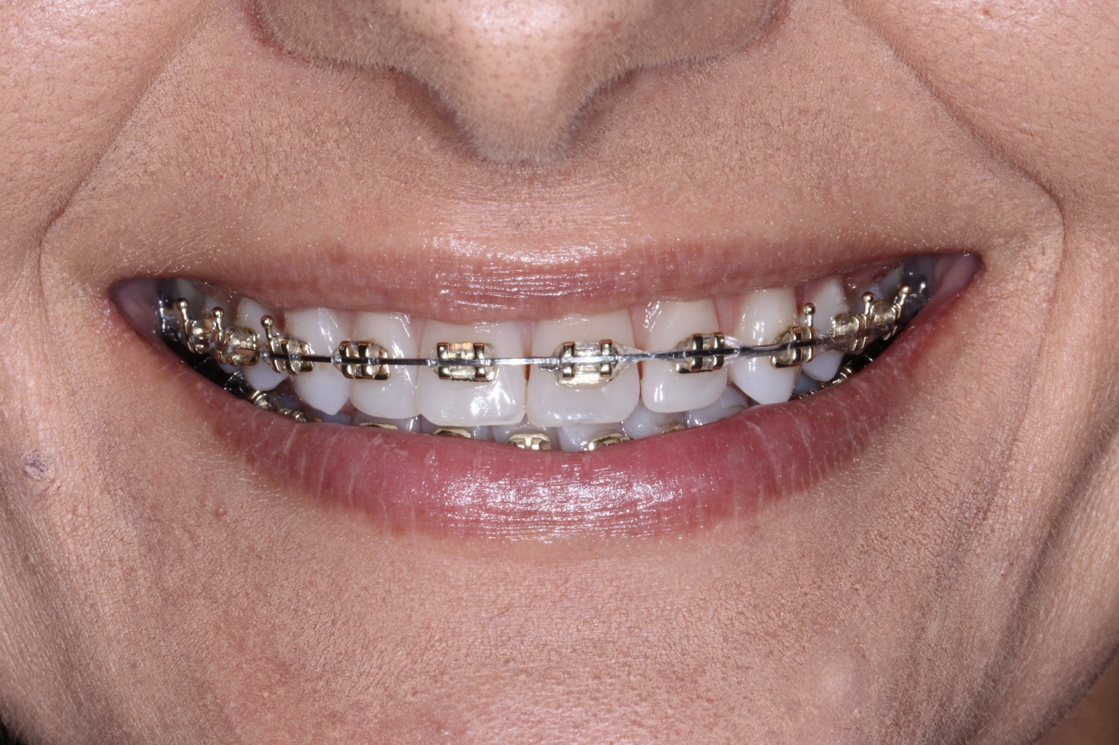 Aparat dentar metalic ⭐ Pentru un zambet frumos, care dureaza!