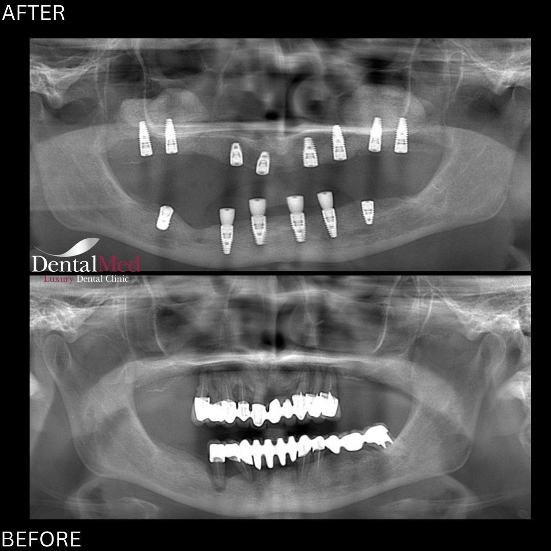 Reconstructie cu implanturi dentare Straumann SLA, pacienti 60+